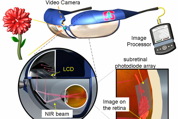 Bionic Eye Could Restore Sight for Many | TIME.com