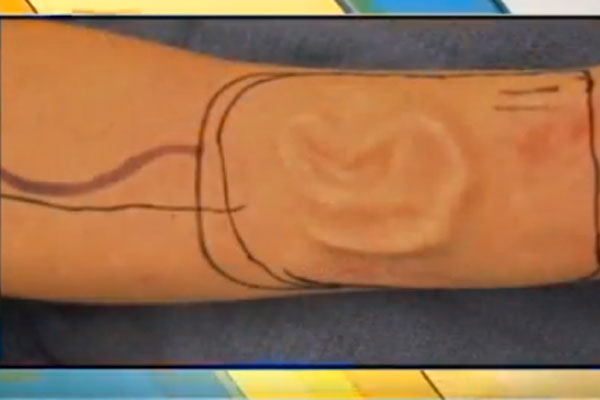 Surgeons Grow a Replacement Ear for Cancer Patient — On Her Arm | TIME.com