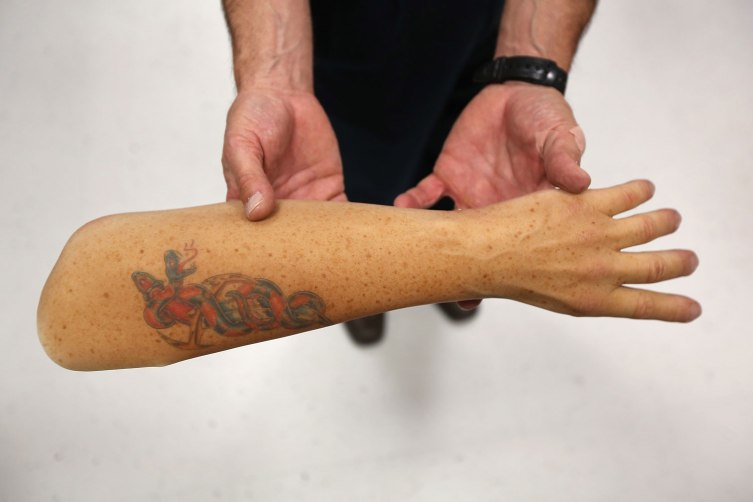 Life-Like Arm, With Tattoo | Prosthetics Through the Years: Ingenius ...