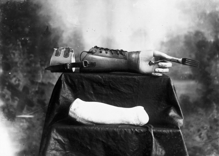 Prosthetic Hand With Fork | Prosthetics Through the Years: Ingenius ...